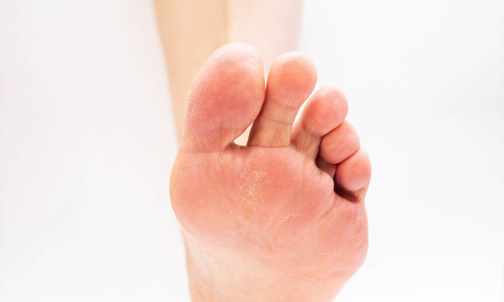 Cutaneous hyperkeratosis: what it is and how to treat it
